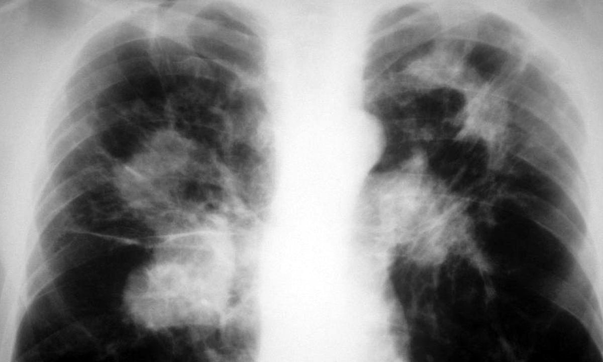 Paralija: U Federaciji BiH u 2021. godini od tuberkuloze oboljele 293 ...